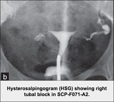 SCP-F071 - Volatile Succubus - Chapter 1 - TheRightArm - SCP Foundation ...