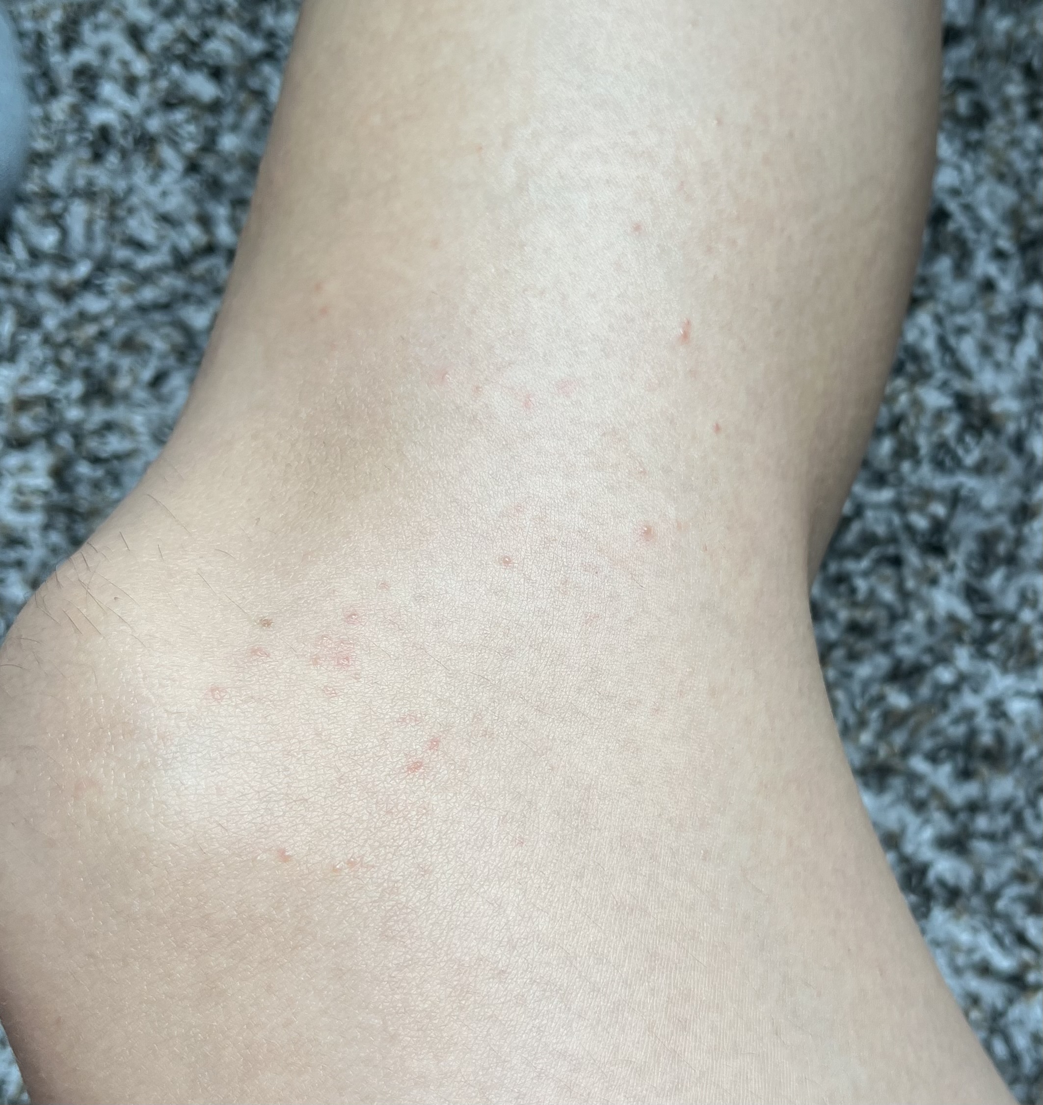 what kind of rash is this : r/AskDocs